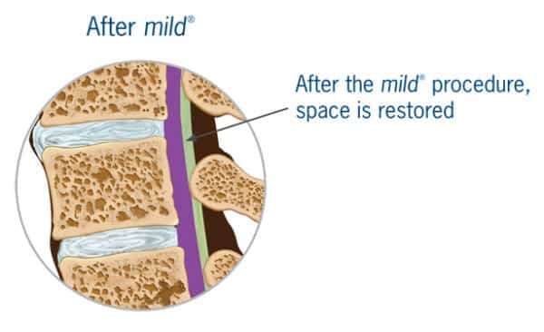 Minimally Invasive Lumbar Decompression | Spine & Orthopedic Center