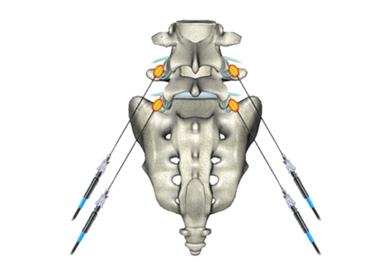 Radiofrequency Ablation Demystified | #1 Spine & Orthopedic Center