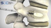Kyphoplasty Surgeon South Florida | #1 Spine & Orthopedic Center