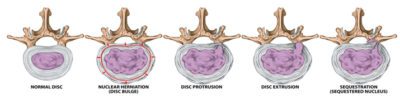 Herniated Disc Symptoms & Treatment | Spine & Orthopedic Center