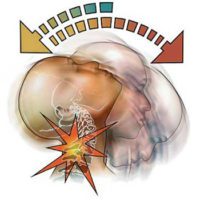Whiplash Injury | Symptoms and Treatments | Spine & Orthopedic Center