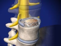 Anterior Lumbar Interbody Fusion (ALIF) | Spine & Orthopedic Center
