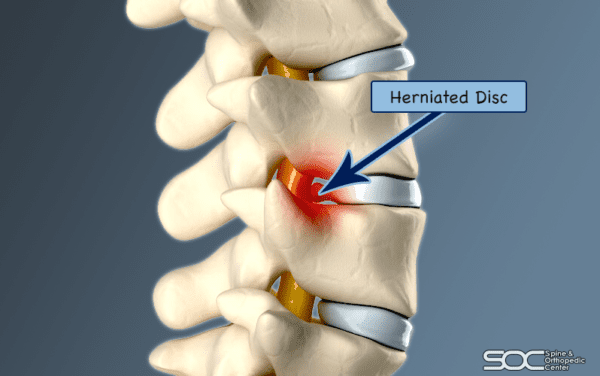 Common Herniated Disc Procedures | Spine & Orthopedic Center