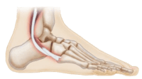 Peroneal Tendonitis Symptoms & Treatments | Spine & Orthopedic Center
