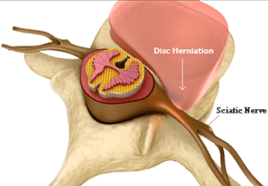 Sciatica Treatment #1 Center in South Florida | Spine & Orthopedic Center