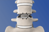 Total Disc Replacement Procedure Specialists | Spine & Orthopedic Center