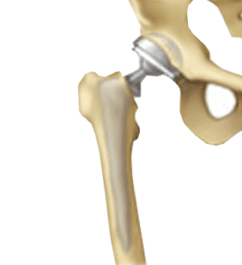 Minimally Invasive Hip Replacement Surgery | Spine & Orthopedic Center