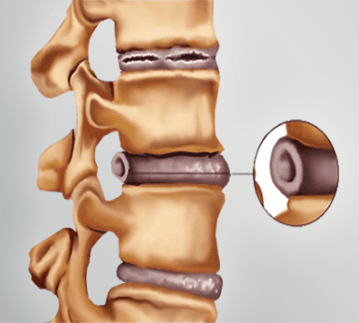 What is a bulging disc? | Spine & Orthopedic Center