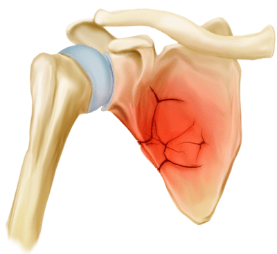 Scapula Fracture (Broken Shoulder Blade) | Spine & Orthopedic Center