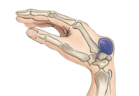 Ganglion Cyst | Symptoms & Treatment | Spine & Orthopedic Center