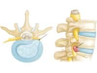 What is a Slipped Disc? | Spine & Orthopedic Center