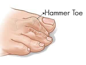 Hammertoe Treatment & Repair Surgery | Spine & Orthopedic Center