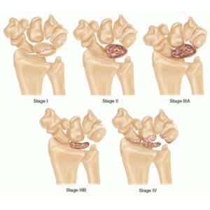 Kienbock’s Disease | Treatment & Diagnosis | Spine & Orthopedic Center