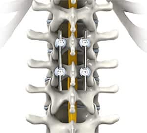 Thoracic Spinal Fusion - Spine & Orthopedic Center