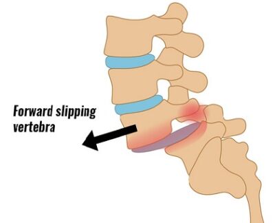 What is Spondylolisthesis? Causes & Symptoms | Spine & Orthopedic Center
