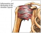 Frozen Shoulder: Causes & Symptoms | Spine & Orthopedic Center