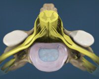What is an Annular Tear? Diagnosis and Treatment | Spine & Orthopedic ...