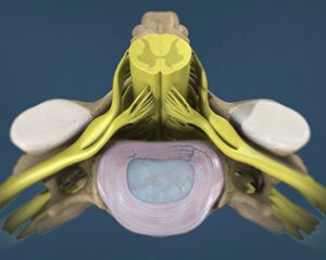 What is an Annular Tear? Diagnosis and Treatment | Spine & Orthopedic ...