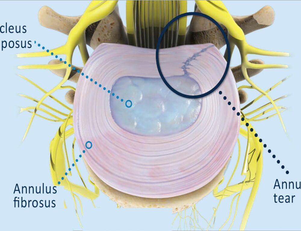When Foot Pain is a from a Spinal Problem | Spine & Orthopedic Center