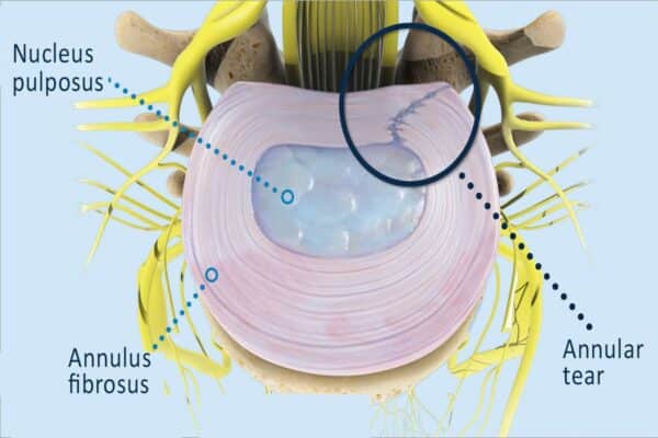 When Does an Annular Tear Require Surgery | Spine & Orthopedic Center