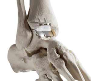 Total Ankle Replacement Specialists | Spine & Orthopedic Center