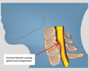 What is Myelopathy? Symptoms & Treatment | Spine & Orthopedic Center