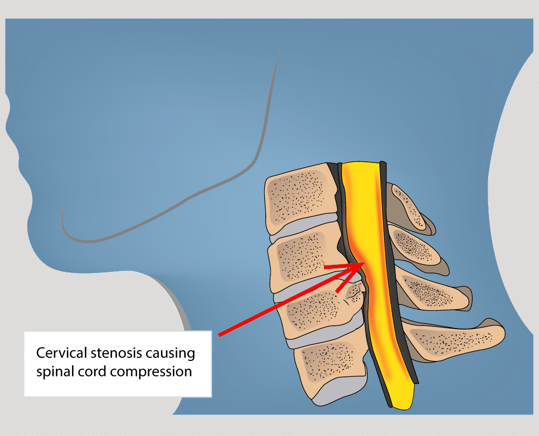 What Is Myelopathy Symptoms Treatment Spine Orthopedic Center