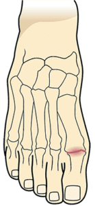 Hallux Rigidus: Causes, Symptoms & Treatment | Spine & Orthopedic Center