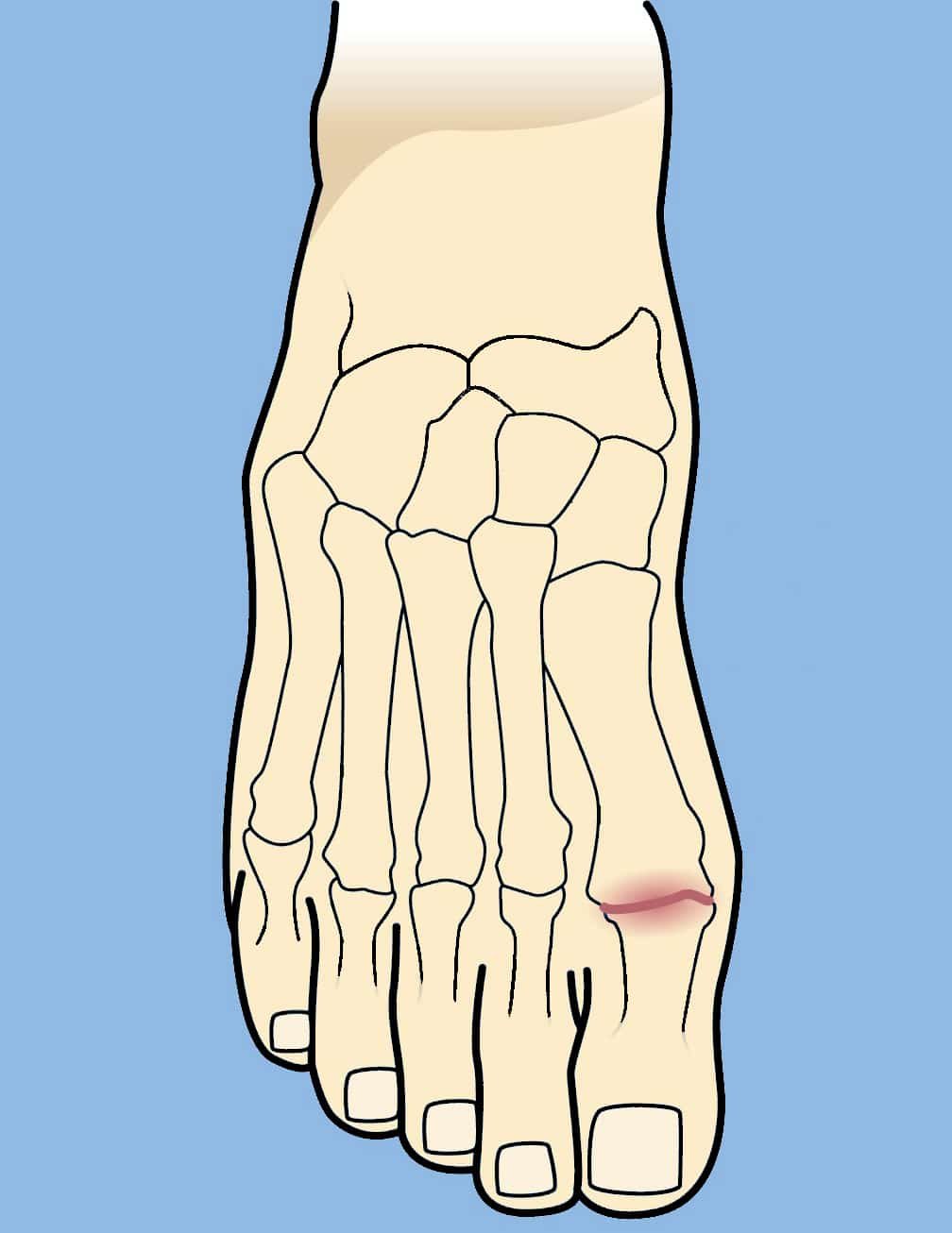 Hallux Rigidus: Causes, Symptoms & Treatment | Spine & Orthopedic Center