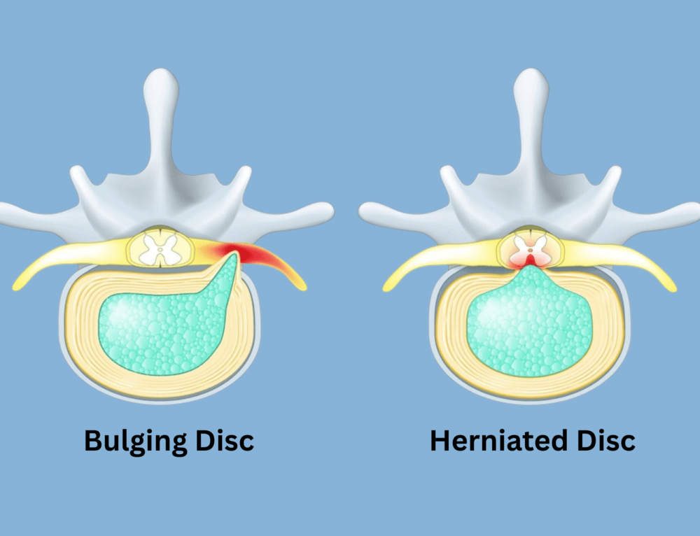 Why Are My Herniated Disc Symptoms Worse in the Morning? | Spine ...