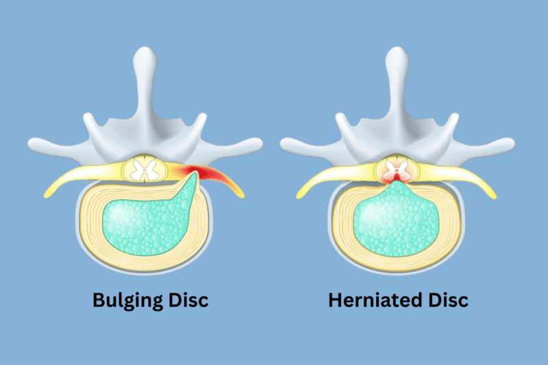 differente between bulging and herniated disc Archives - Spine ...